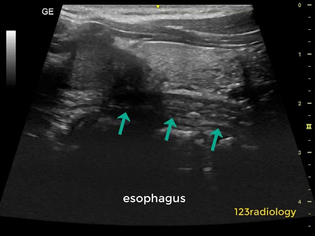 Esophageal Atresia Ultrasound