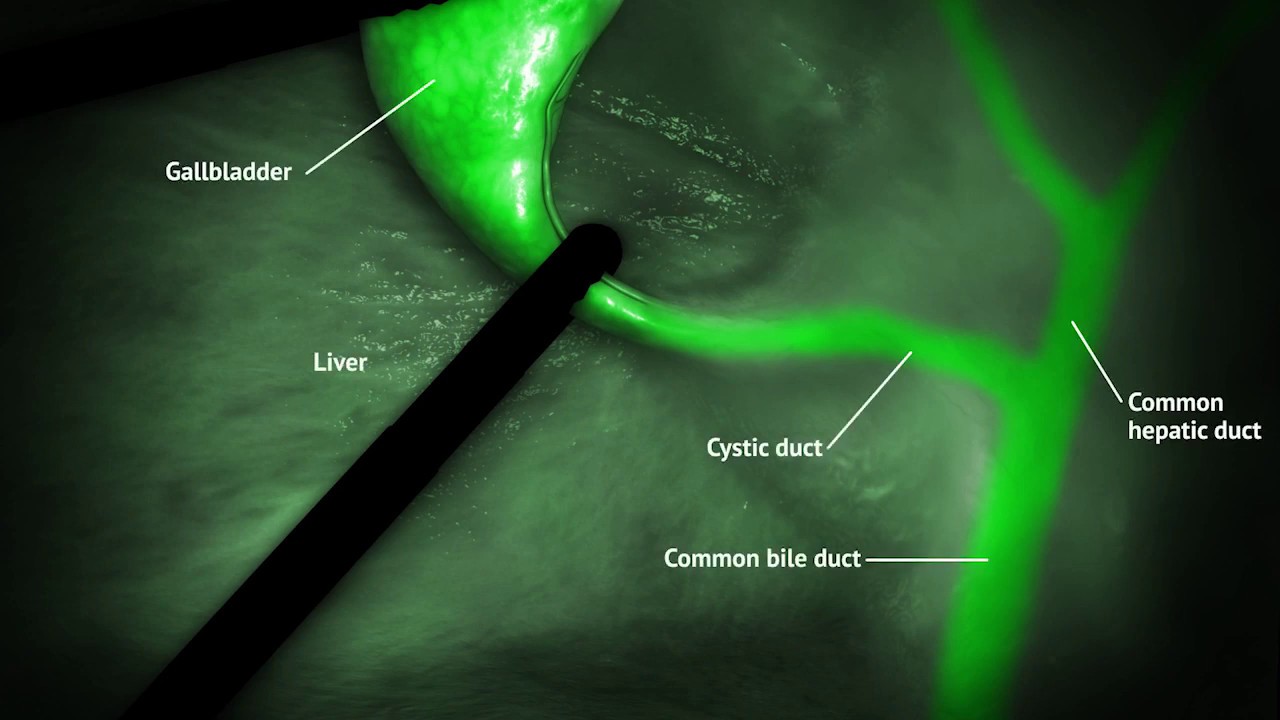 Fluorescence Guided Surgery Colectomy - YouTube