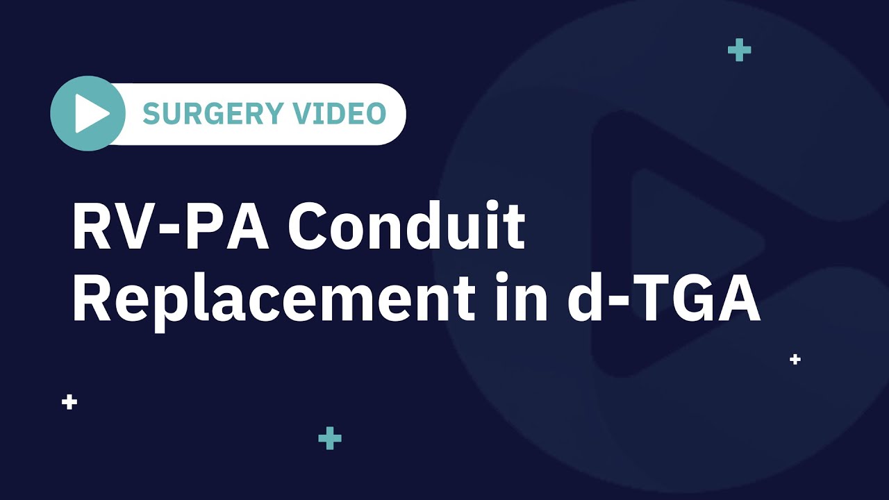 Surgery Video: RV-PA Conduit Replacement in d-TGA - YouTube