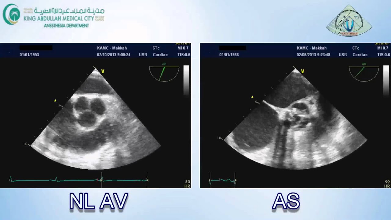 023 AV Pathology 2D SAX TEE KAMC - YouTube