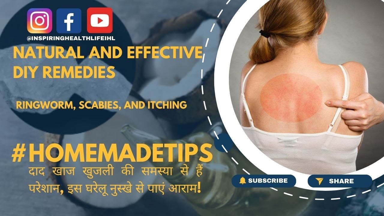 DIY Home Remedies for Ringworm, Scabies, and Itching | Alum, Aloe Vera ...