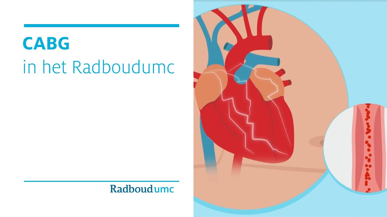 CABG - bypassoperatie - YouTube