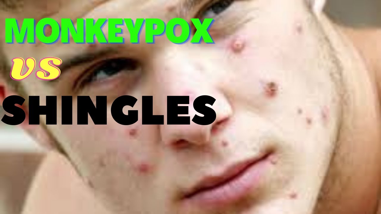 Monkey Pox vs Shingles Rash. How To Tell The Difference. - YouTube