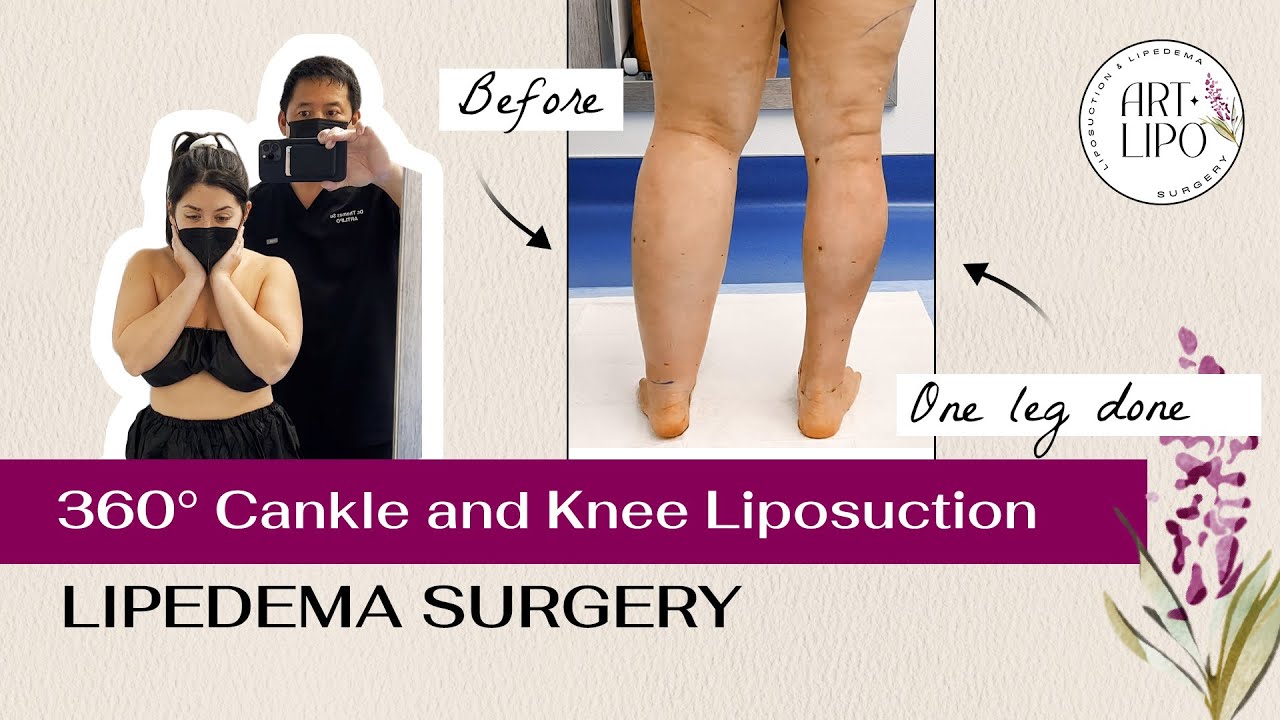360° CANKLE & KNEE LIPOSUCTION | Lipedema | Artlipo | Expert Dr. Thomas ...