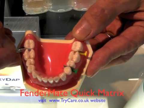 Trycare FenderMate quick dental matrix for fillings 4everlearning CPD ...