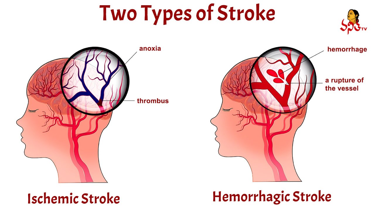 Types Of Strokes Ischemic Stroke Vs Hemorrhagic Stroke Neurologist Types Of Strokes Ischemic Stroke Vs Hemorrhagic Stroke Neurologist