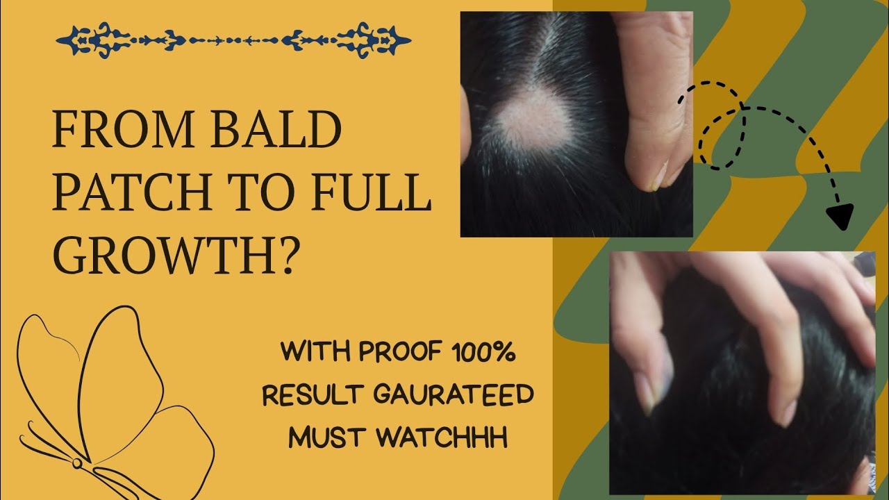 BALD PATCHES TO HAIR GROWTH 😳Must watchhhhhh - YouTube