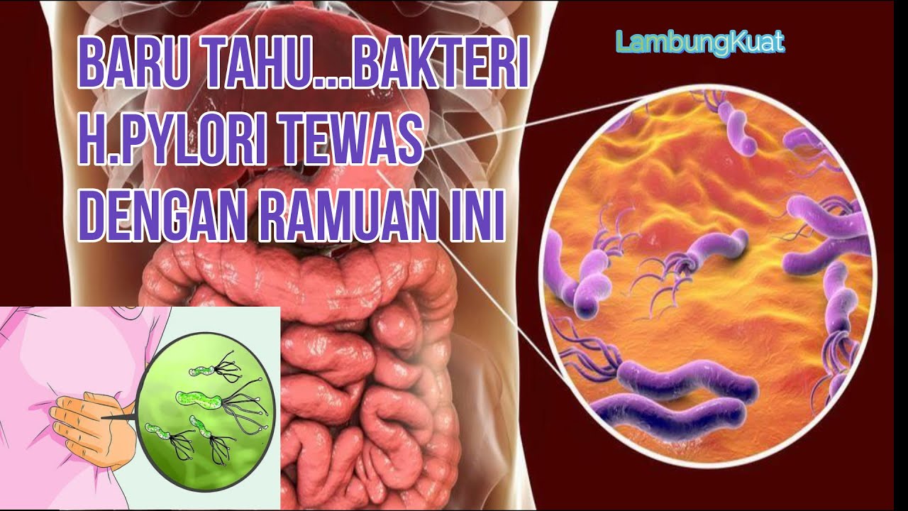 Ramuan pembunuh Bakteri H,Pylori - YouTube