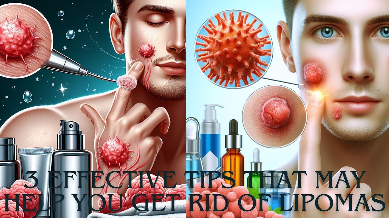 3 effective tips that may help you get rid of lipomas - YouTube