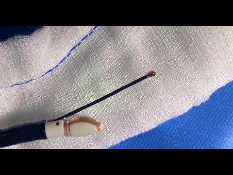 ENDOBRONCHIAL ULTRASOUND - TRANSBRONCHIAL CRYO NODE BIOPSY - EBUS TBCNB - YouTube