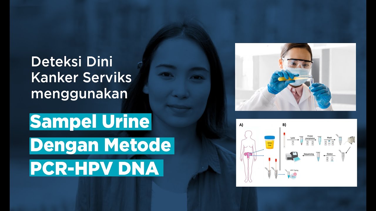 Deteksi Dini Kanker Serviks Menggunakan Sampel Urine Metode PCR HPV DNA ...