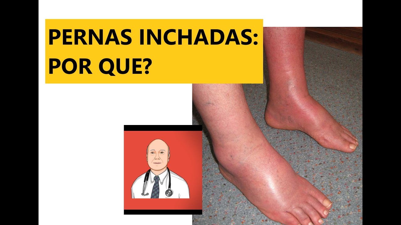 As 9 causas principais de pernas inchadas, com sinais de alerta para ...