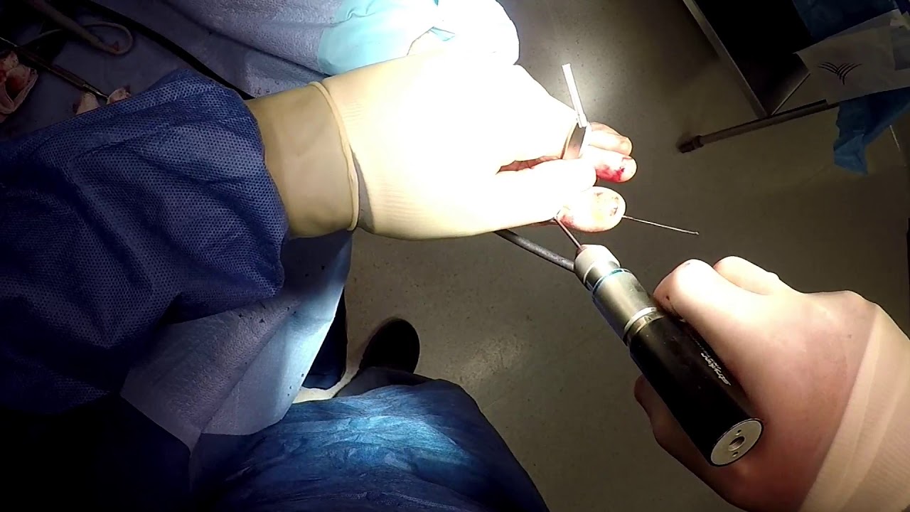 Fusion of the Big Toe - YouTube