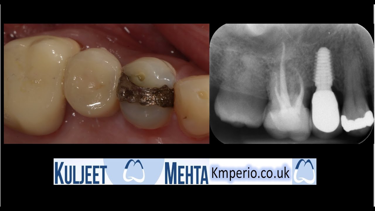 Extraction, Implant with Grafting & Restoration-UR5 - YouTube