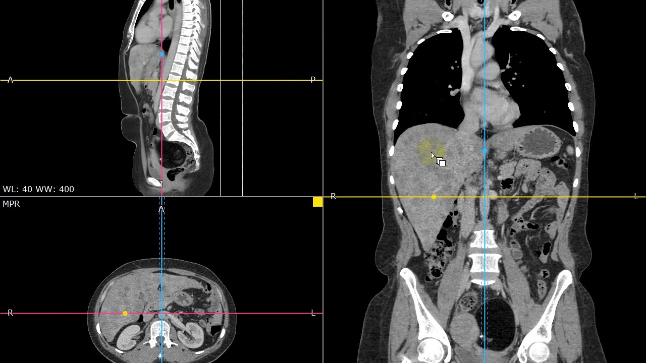 Average Density using RadiAnt Software - YouTube