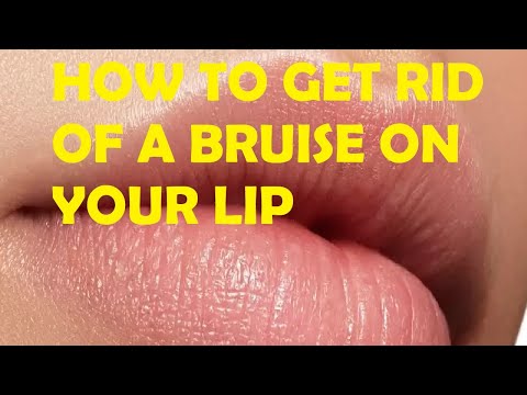 how to get rid of a bruise on your lip fast and easy - YouTube