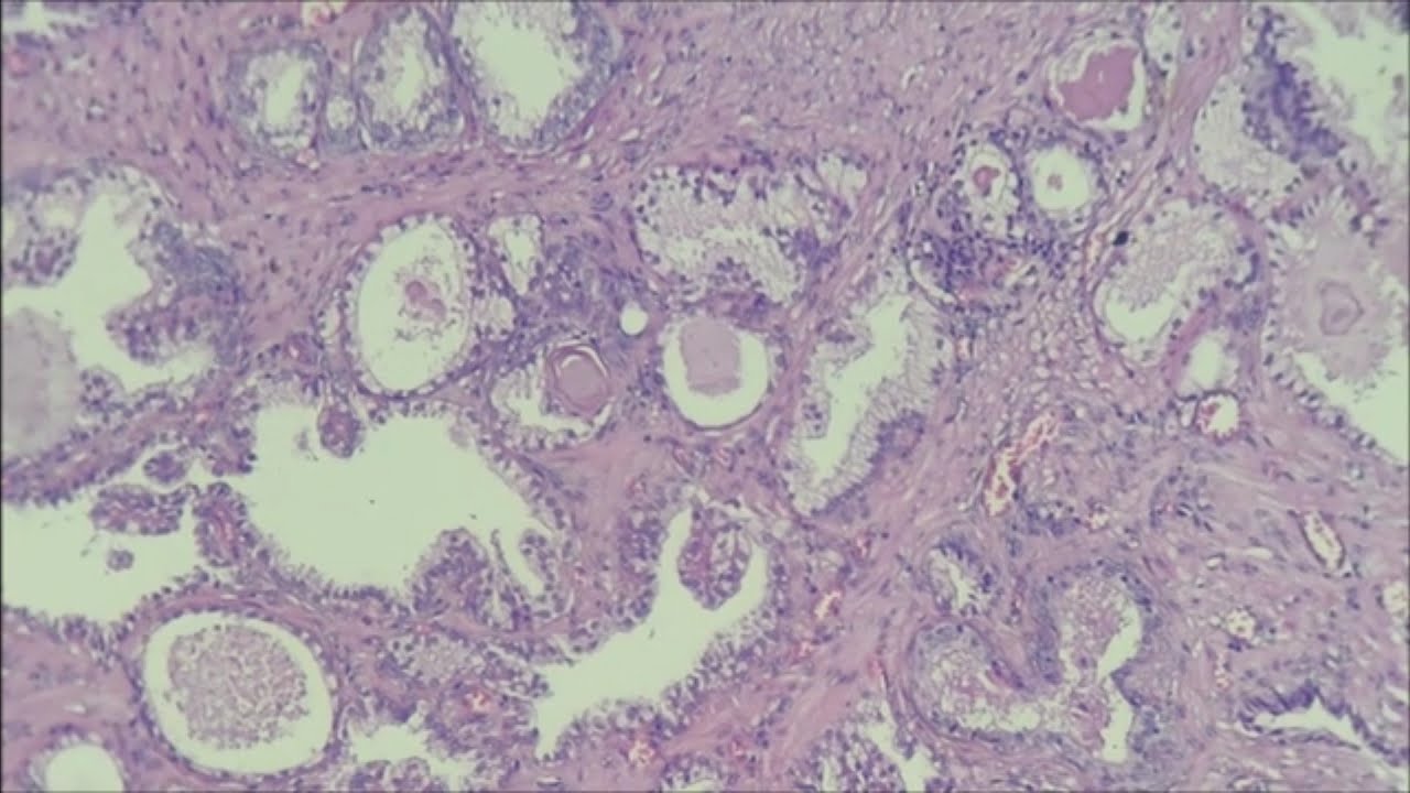 Benign Hyperplasia of prostate - histopathology slides - YouTube