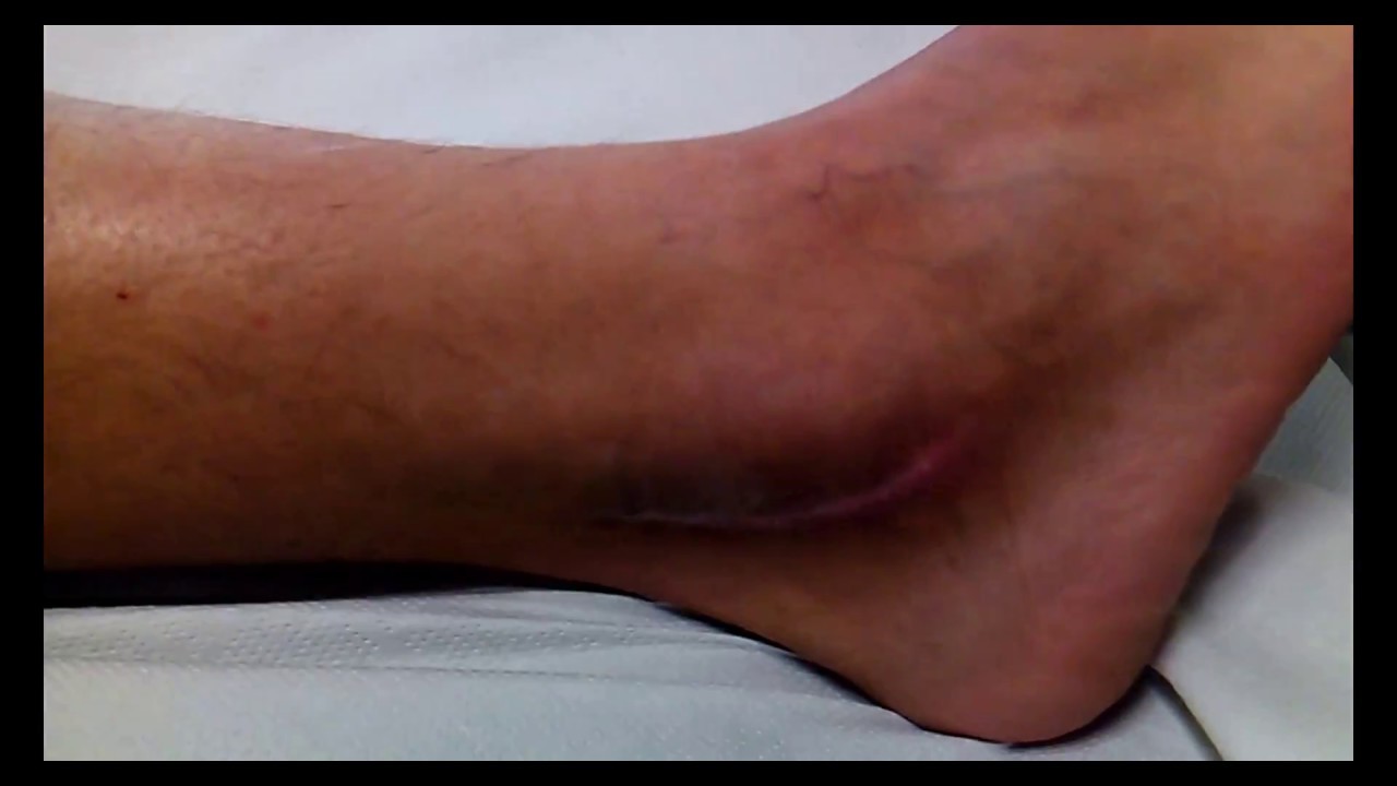luxacion tendones peroneos - YouTube