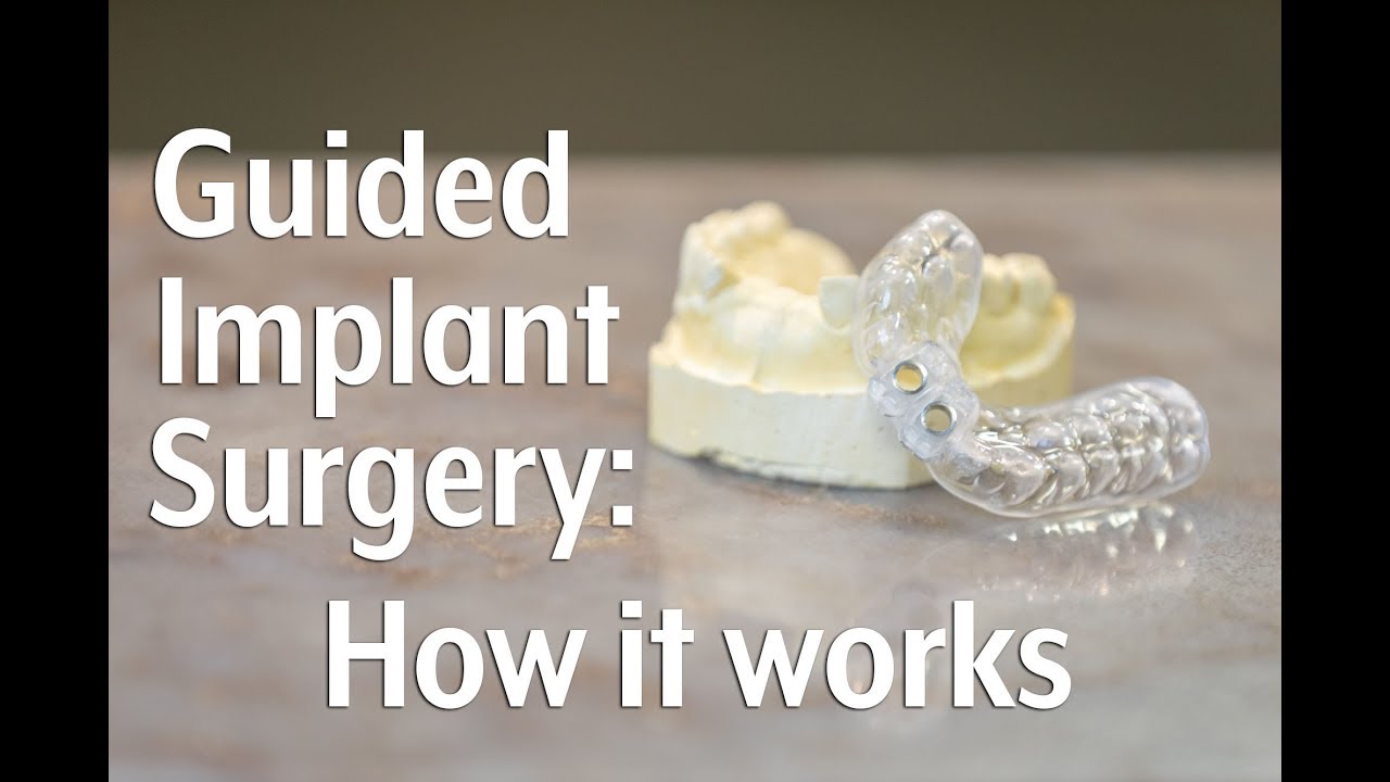 Guided implant surgery - how it works - YouTube