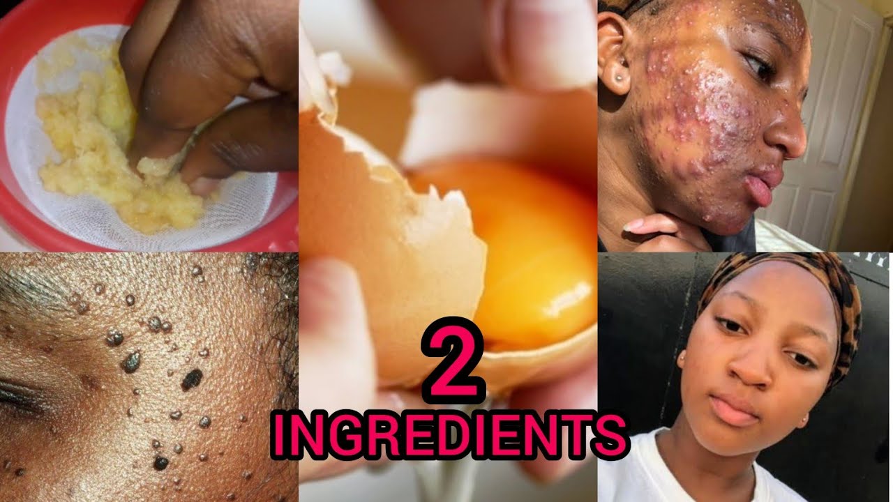 How To Remove BLACK SPOTS, SUNBURN, ACNE, PIMPLES, SKIN TAGS, | Get a ...