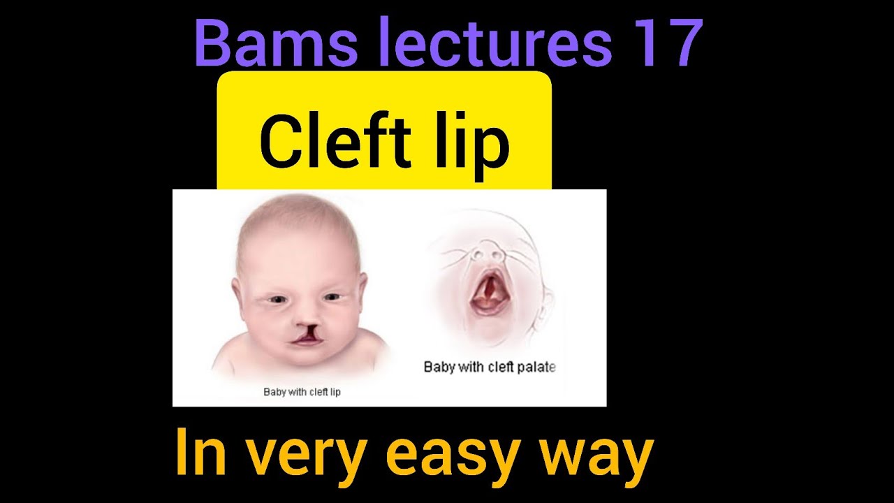 Cleft lip || in very easy way #cleftlip #ent #bams #ayurveda # ...