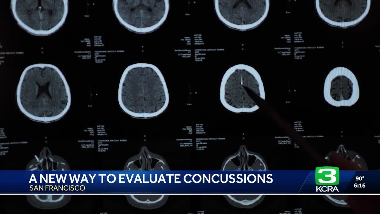 UCSF doctors develop new concussion testing method - YouTube