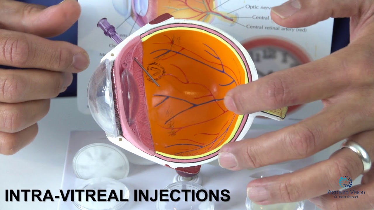 Intra-vitreal or eye Injections more cases - YouTube