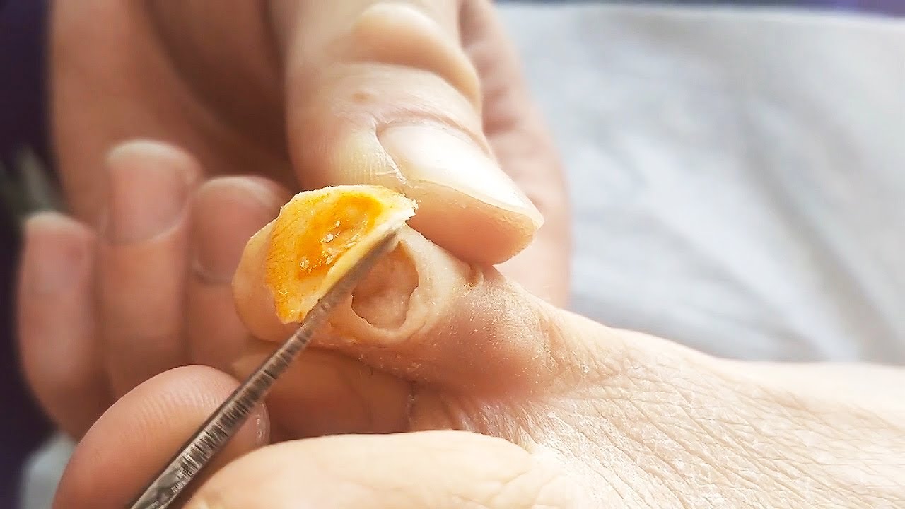 Huge hole! Deep removal of small toe corn-Satisfying & Relaxing Video ...