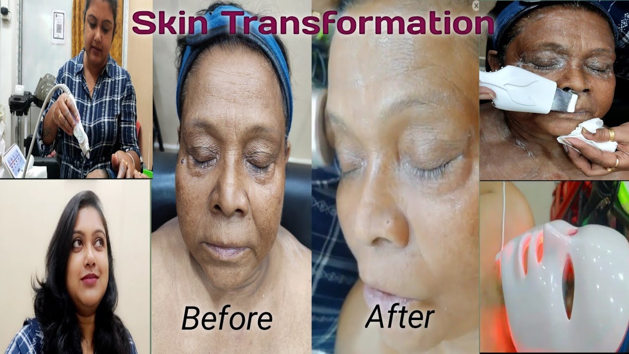 Skin Transformation /Hydra facial/ Step by step for beginners/Advance ...