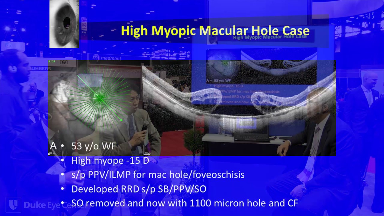 Emerging Data and New Approaches to Retina Surgery - Tamer Mahmoud, MD ...
