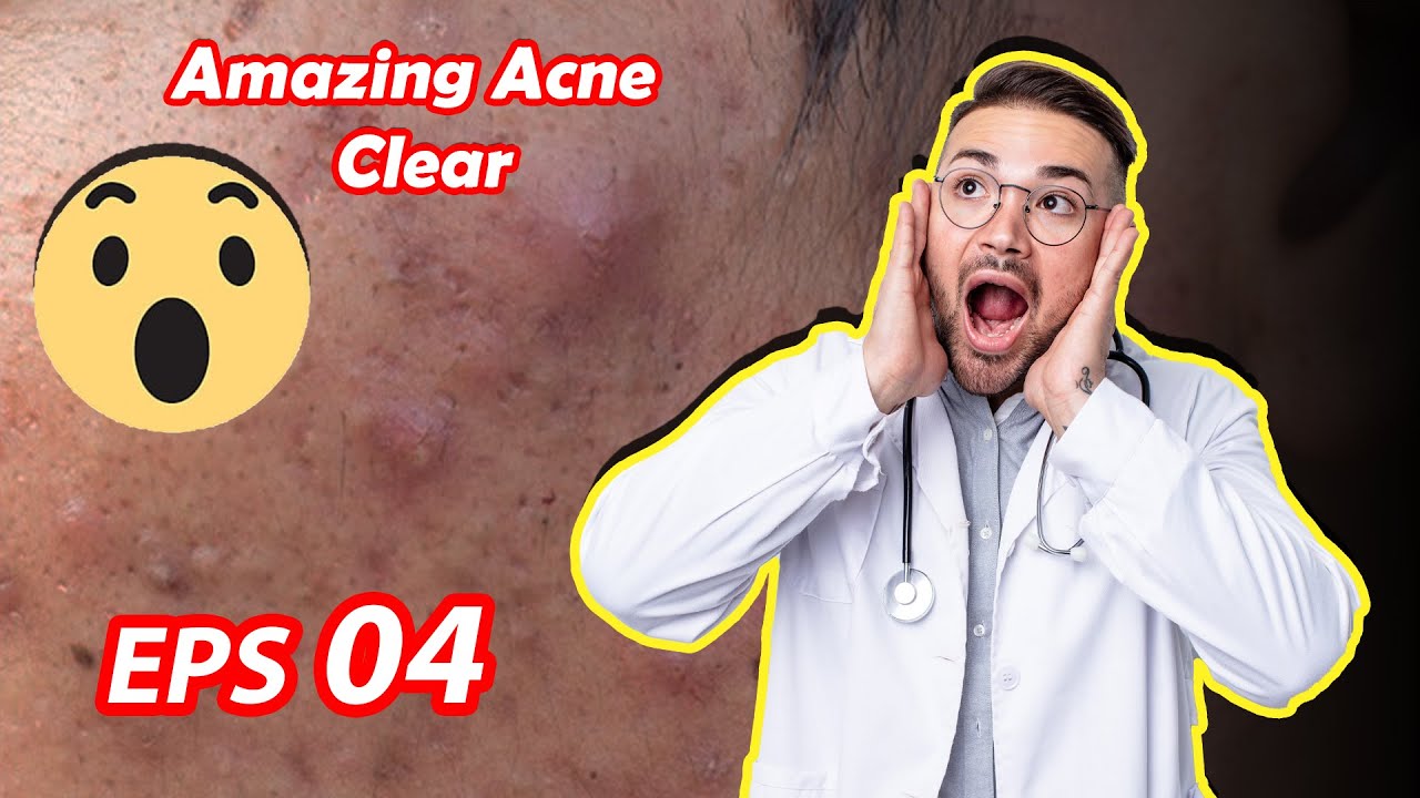 WOW - Super satisfying Blackheads and acne Removal l Eps 04 (Dr.Acne ...