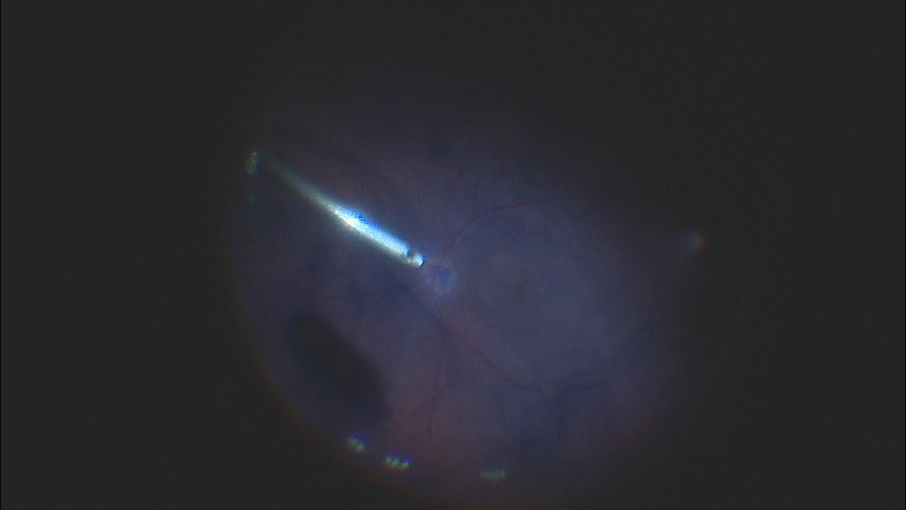 Inverted flap ILM peeling for Macular Hole - YouTube
