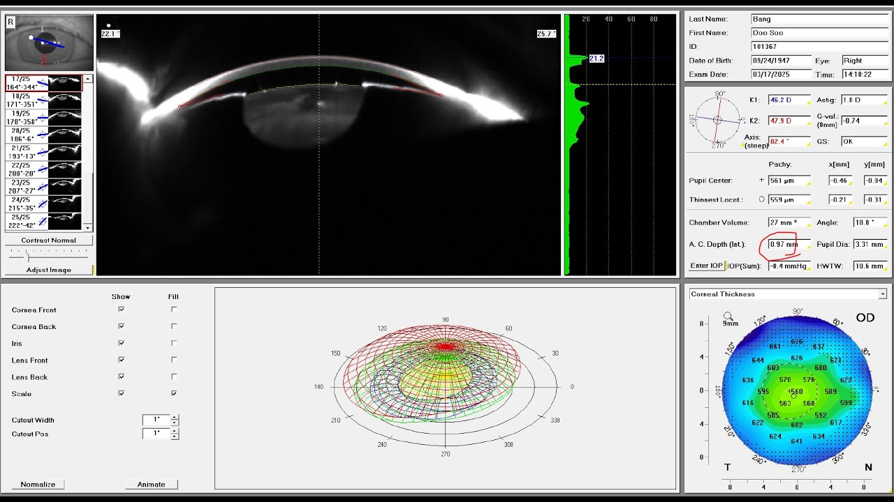 CACG(chronic Angle closure glaucoma) c pxeudoexfoliation cataract ...