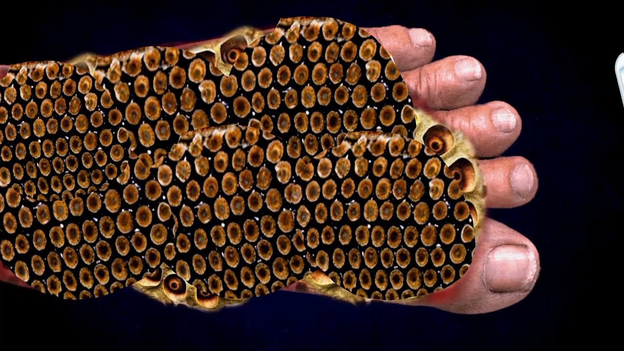 ASMR Maggots Infected Foot Treatment | Deep cleaning animation | ASMR ...