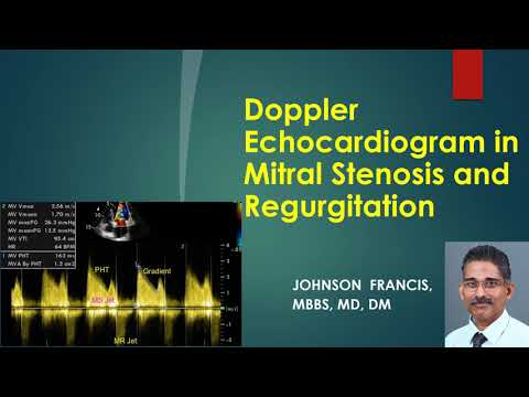 Doppler Echocardiogram in Mitral Stenosis and Regurgitation - YouTube