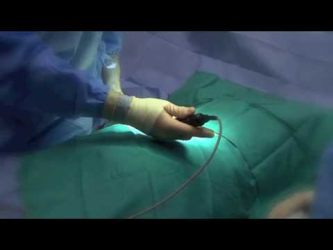 Vaser Hi Def Liposuction "LipoSculpture" - YouTube