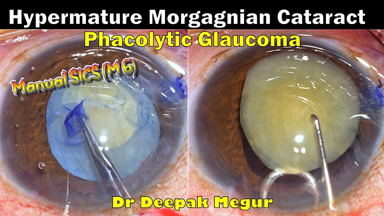 Manual SICS (M 6) - Hypermature Morgagnian Cataract Phacolytic Glaucoma ...