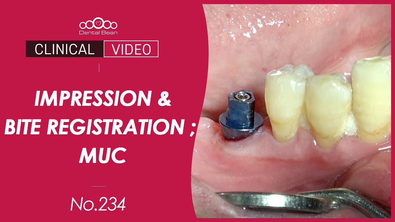 Impression & bite registration ; MUC - [Dr. Na Kiwon] - YouTube