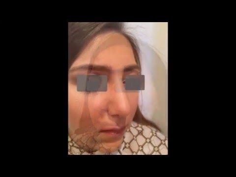 Doctor  Rauf Haqverdiyev  -Rinoplastika