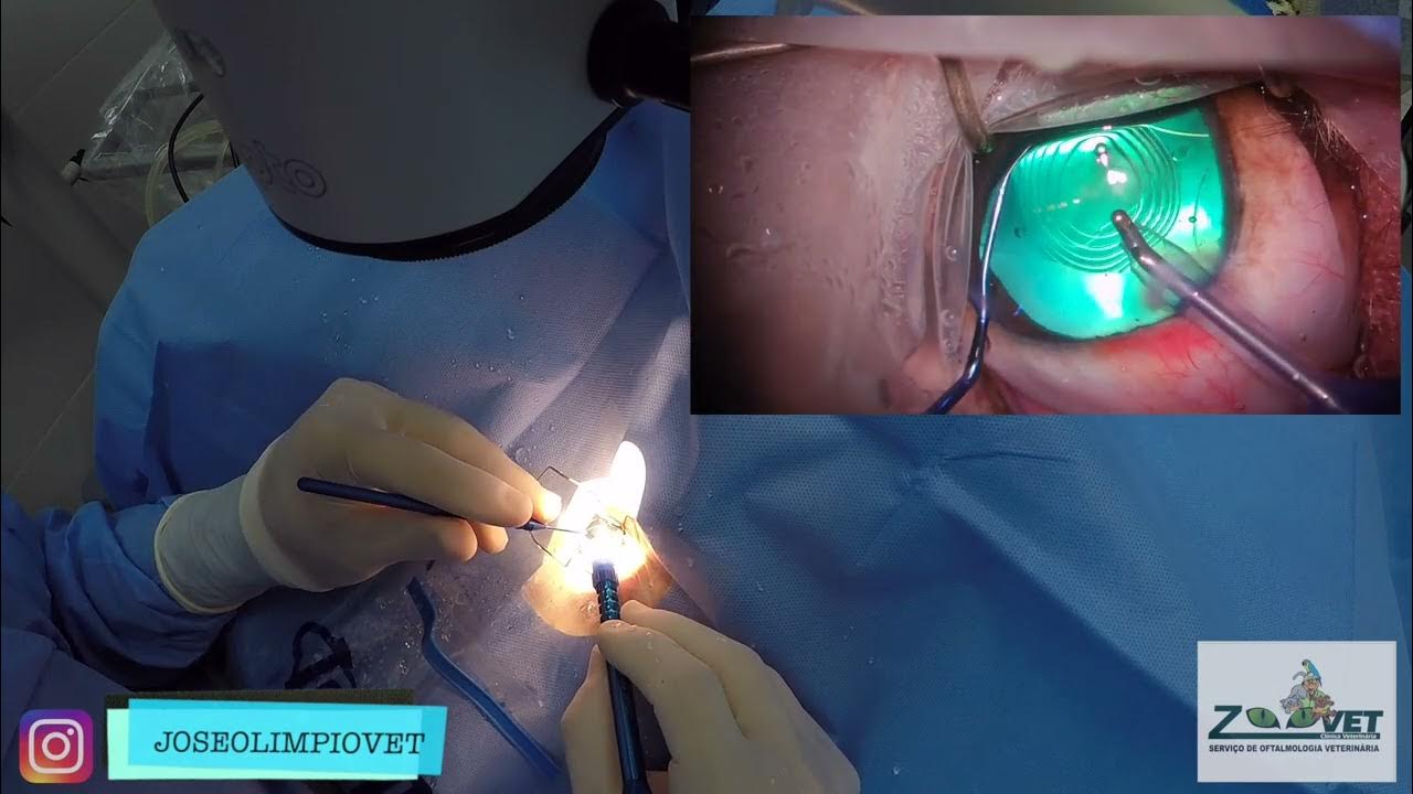 Implante de lente intraocular na cirurgia de catarata - YouTube