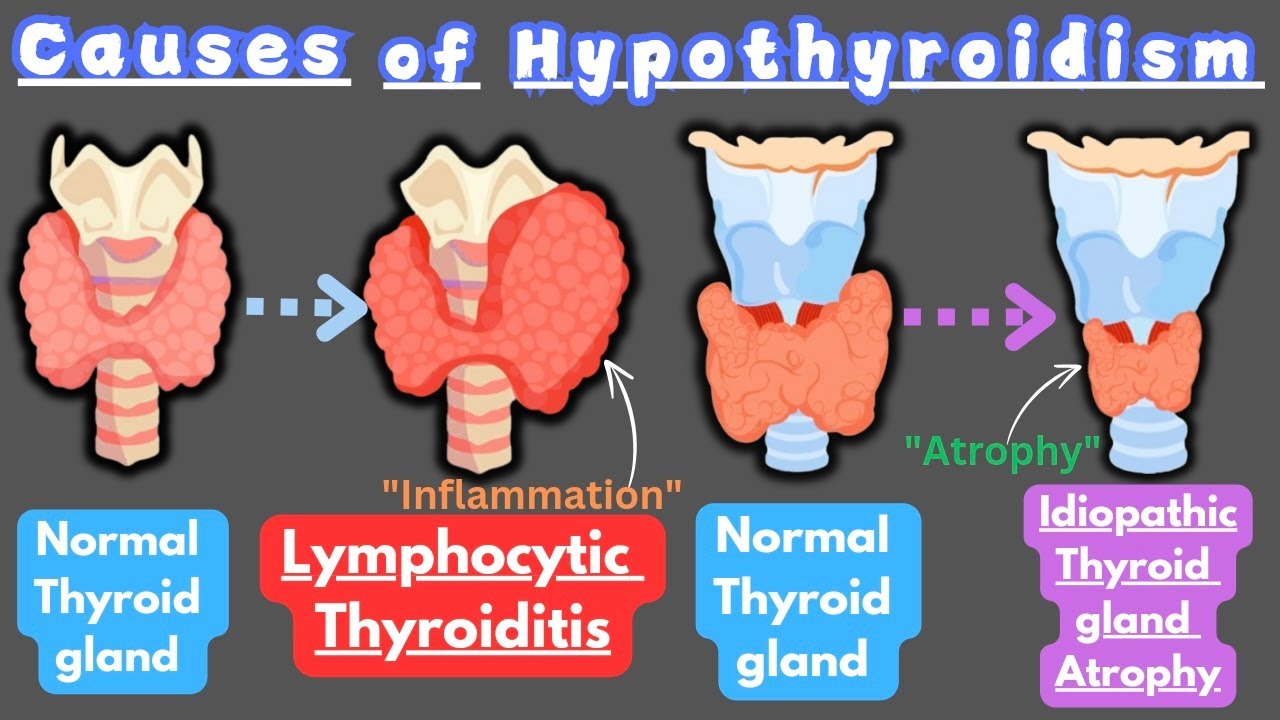 Cause of Hypothyroidism :- Lymphocytic Thyroiditis, Thyroid gland ...