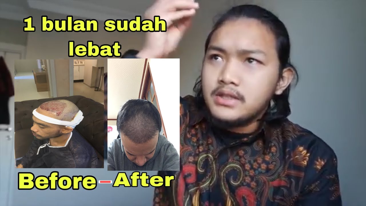 TANAM RAMBUT TRANSPLANTASI DI TURKI - YouTube