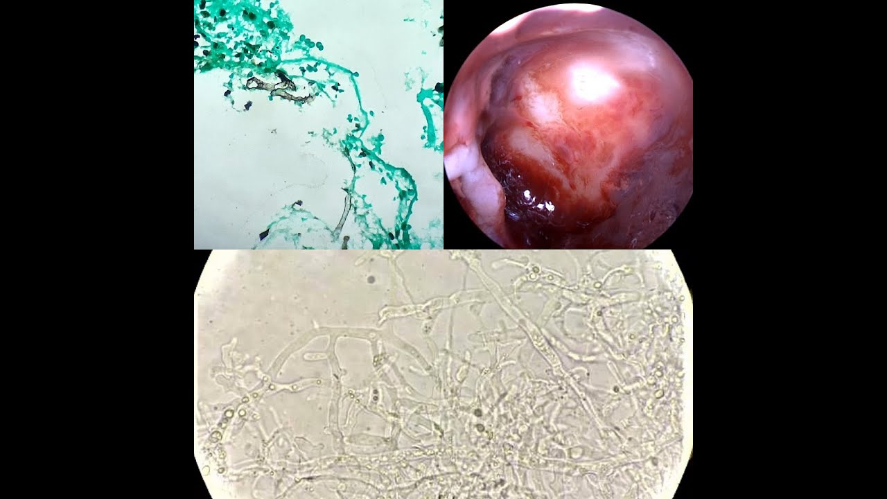 Mucormycosis of Sino-Nasal & Orbit.Case of LEFT EYE INVOLVED WITH B/L ...