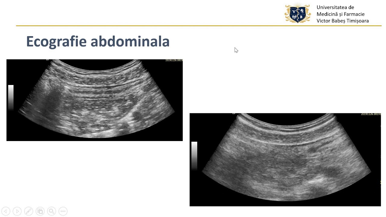 Dr. Felix Bende - Cazuri ecografice de boli inflamatorii intestinale ...