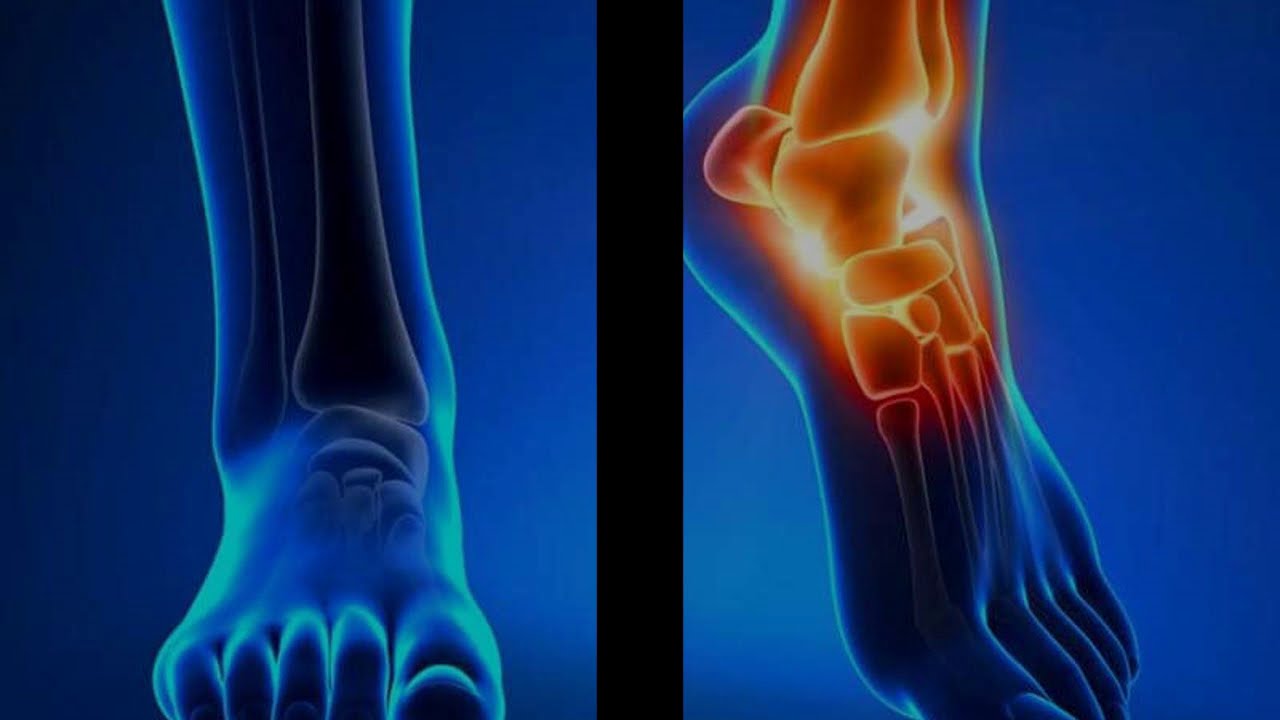 Conoce las Lesiones del pie mas Comunes - Lesiones en ligamentos o ...