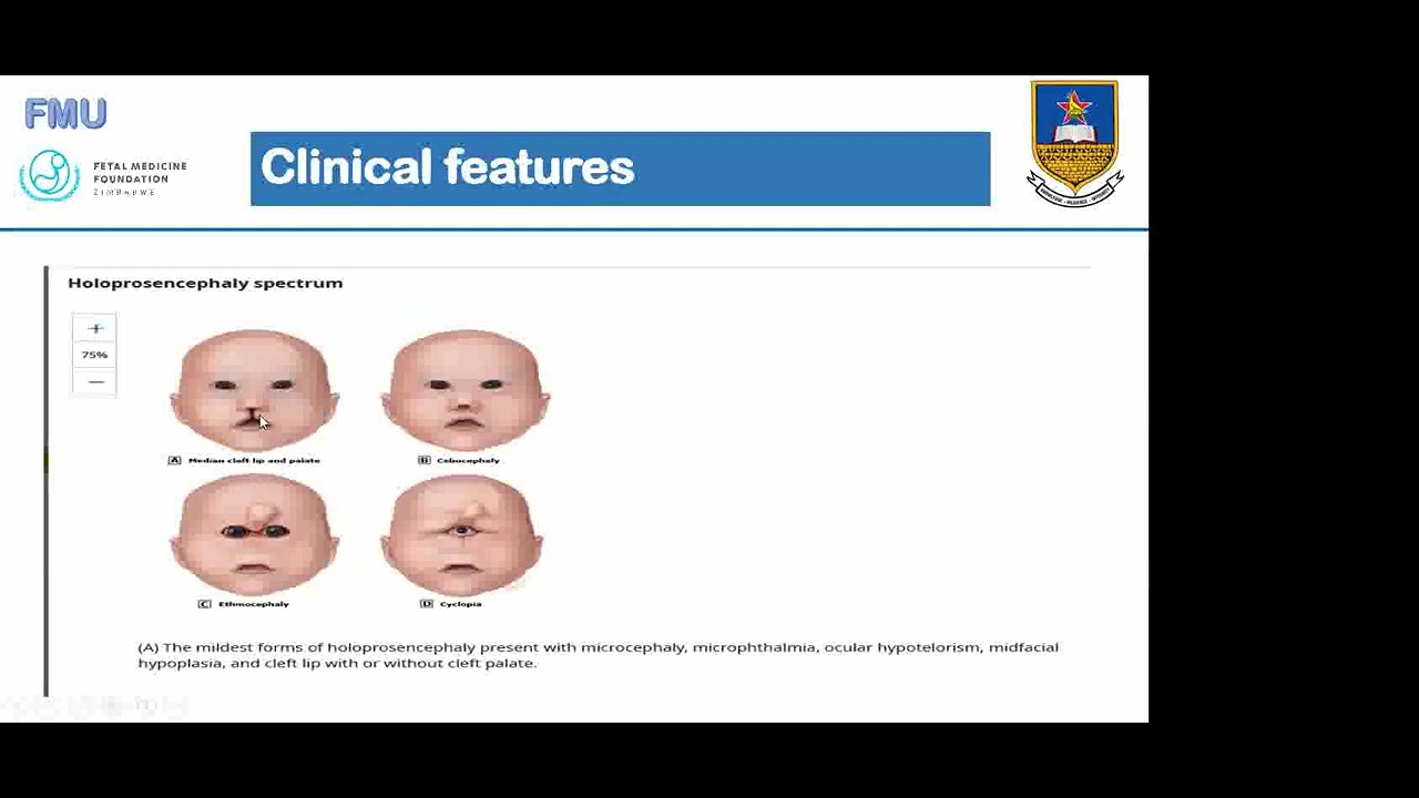 FMU Cases-Alobar holoprosencephaly and Advanced Tubal Pregnancy by Dr T ...