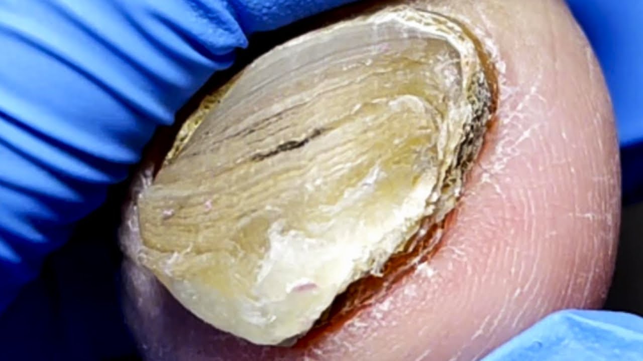 Toenails Are As Hard As Stone, Cut Off The Bad Residue Step By Step ...