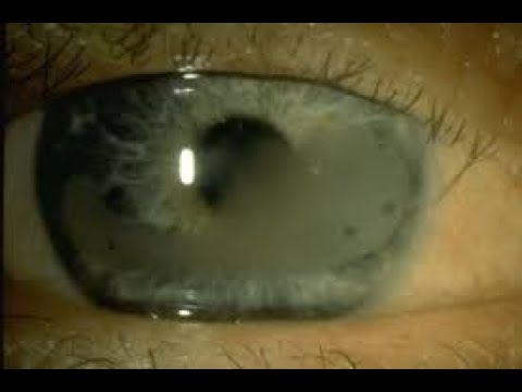 Band keratopathy corneal degeneration characterized by calcium deposits ...