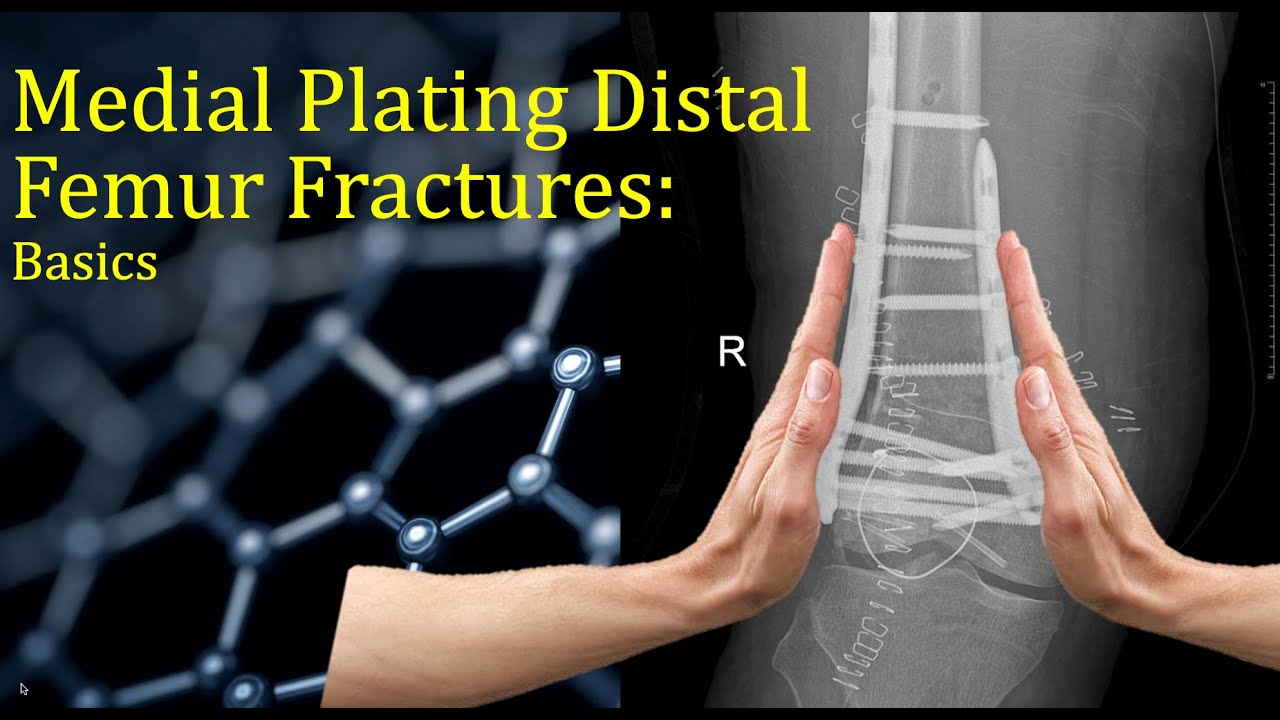 Medial Plating Distal Femur Fractures: Basic Understanding - YouTube