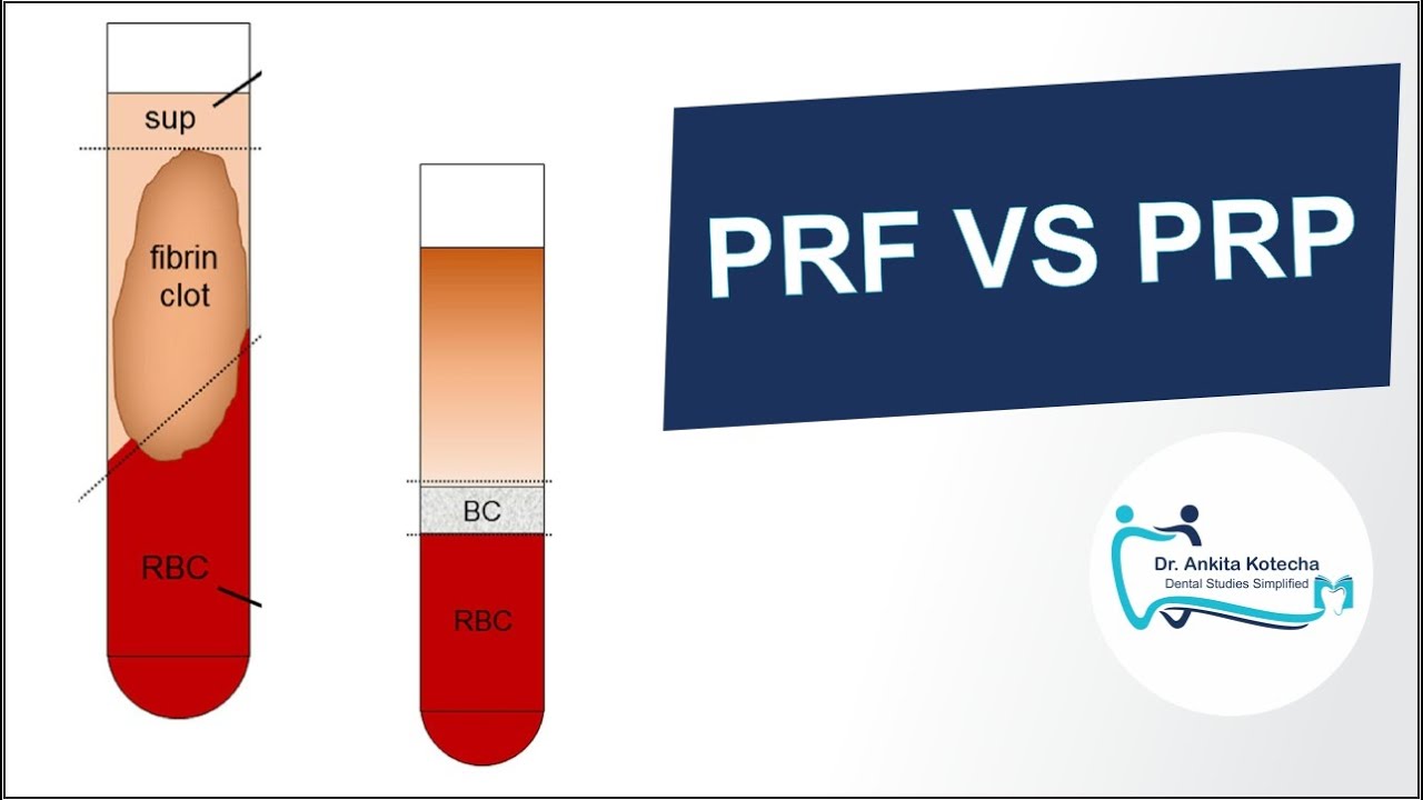 PLATELET RICH PLASMA (PRP) vs PLATELET RICH FIBRIN (PRF)/SUMMARY ...